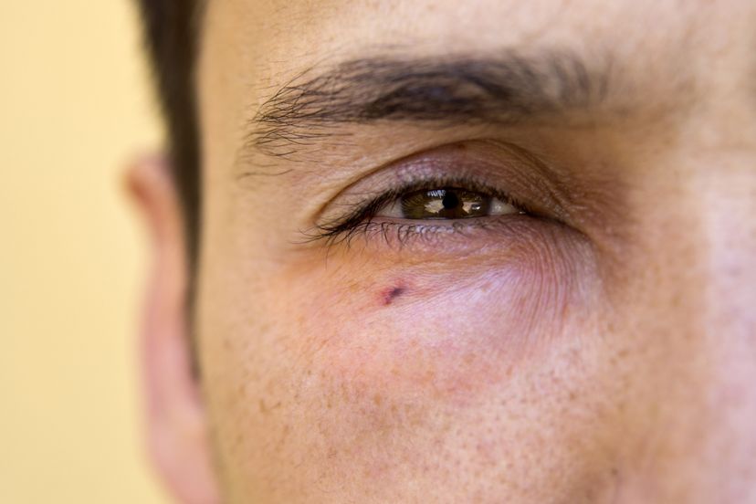 7 picaduras de insectos que indican que deberías ir al médico