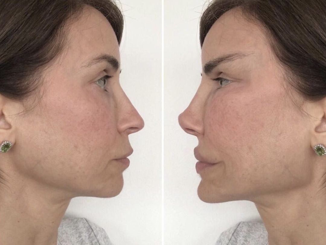 Un cirujano plástico muestra cómo el exceso de bótox hace que las ...